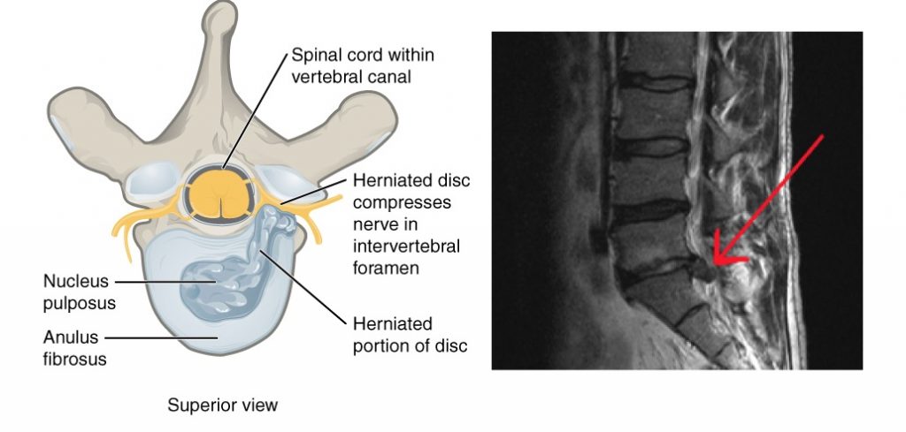 Arlington Heights Chiropractor Helps Bulging, Herniated and Degenerated ...